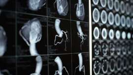 Pediatric Myocarditis: Diagnosis & Care